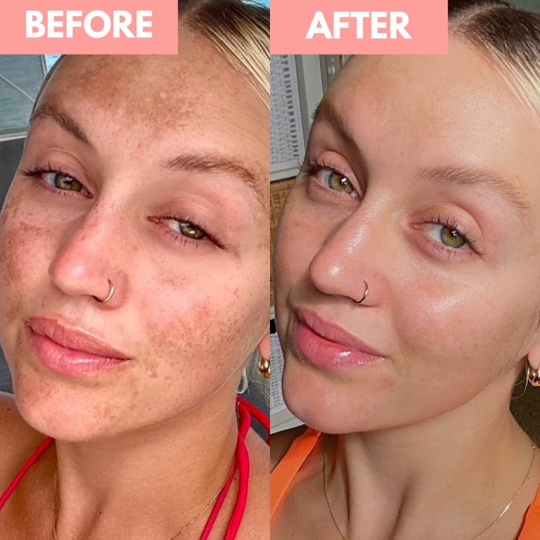 Meet The Australian Made Three Step Skin Routine That Combats Melasma ...